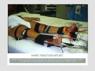 Skeletal Traction Femur Fracture