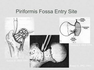 Piriform Fossa Femur
