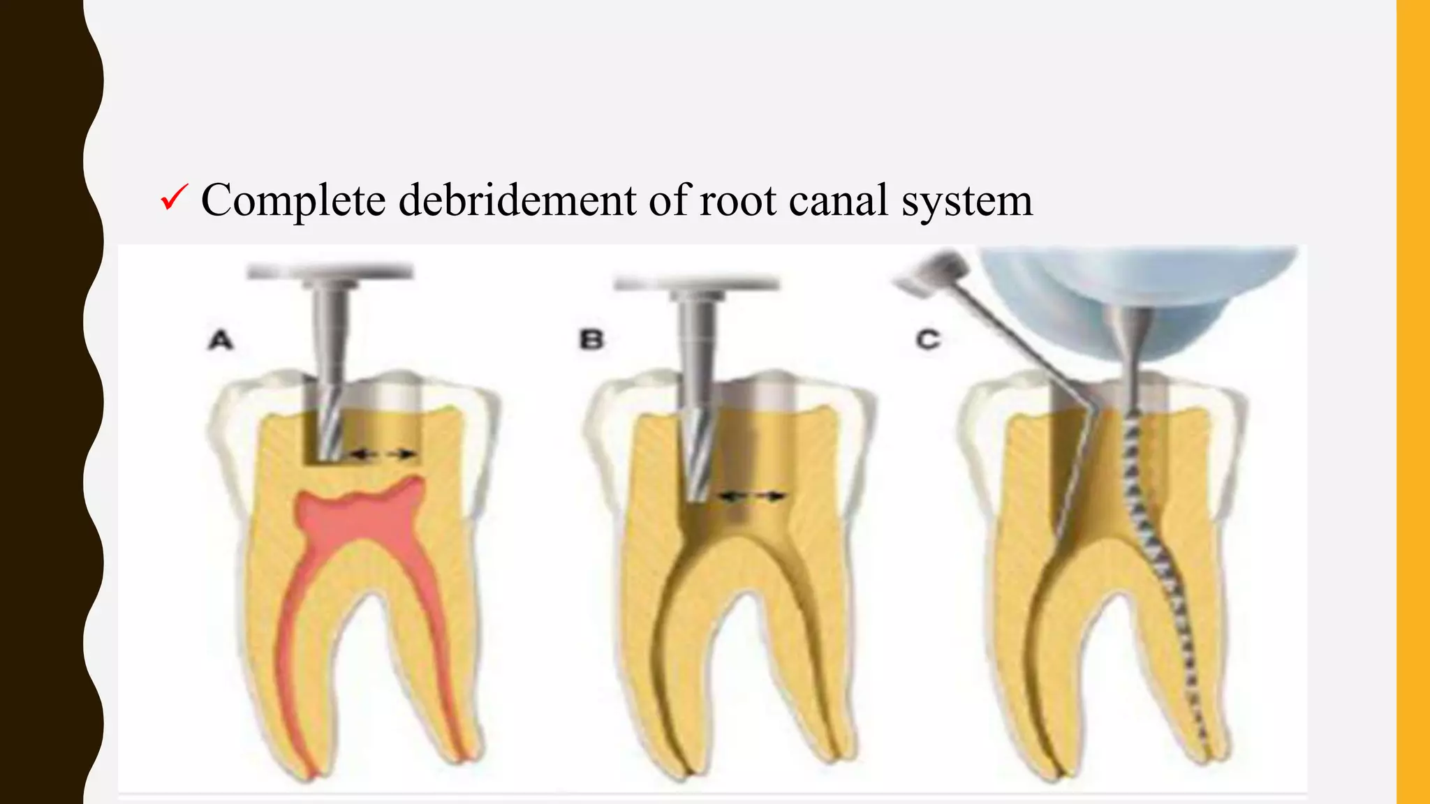 Mid treatment flare ups in endodontic | PPTX