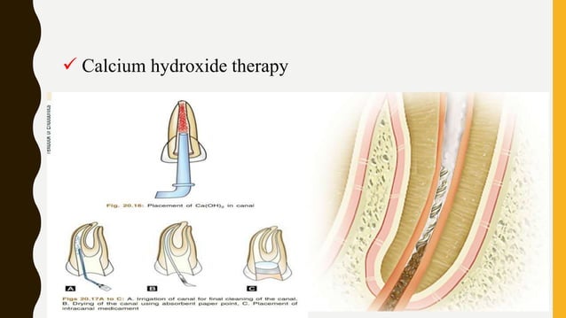 Mid treatment flare ups in endodontic | PPTX | Dental Health | Diseases ...