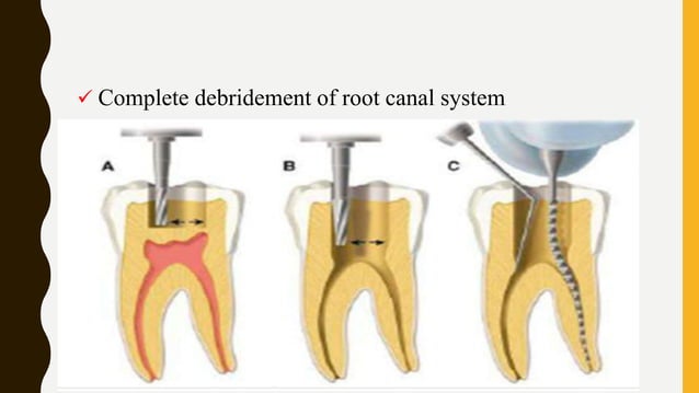 Mid treatment flare ups in endodontic
