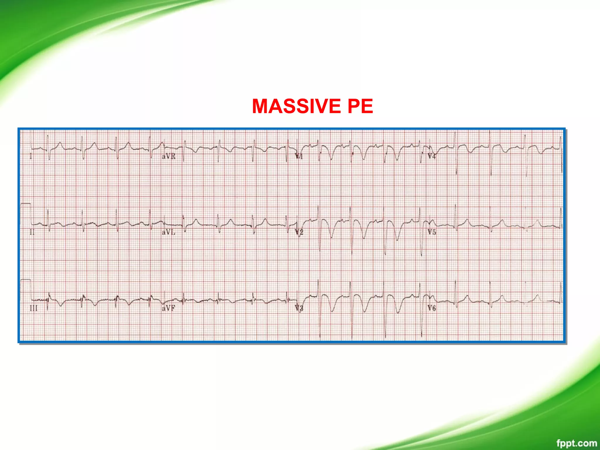 Myocardial infarction (MI) ecg localisation | PPT