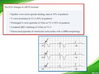 Acute Mi Ecg Tracing