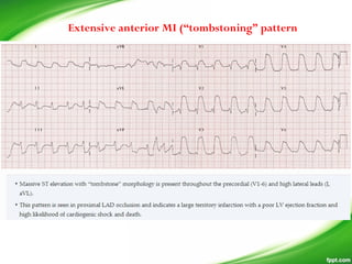 Anterior Myocardial Infarction Ecg