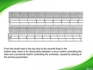 Myocardial Infarction Ecg Strip