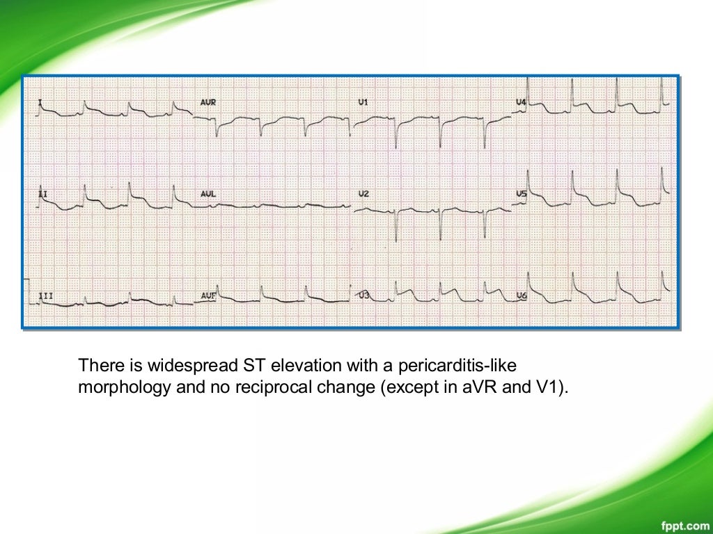 Myocardial infarction (MI) ecg localisation