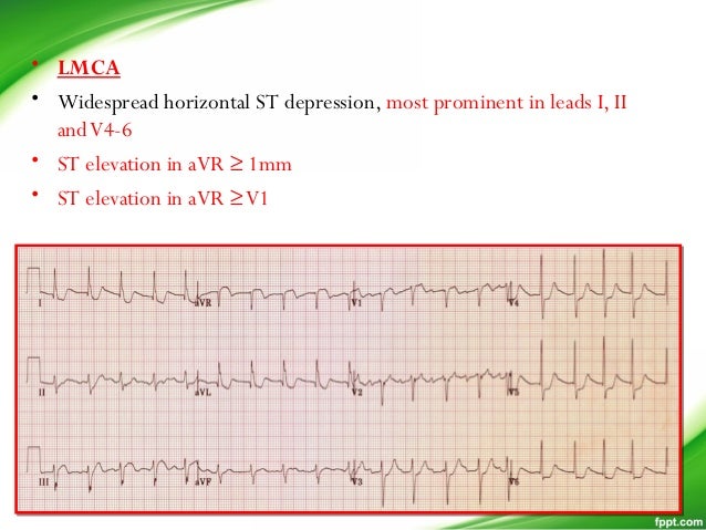 Myocardial infarction (MI) ecg localisation