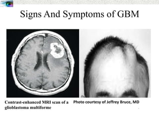 brain tumor (gbm). | PPTX