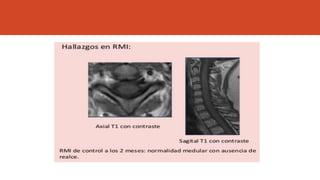Mielitis transversa | PPTX