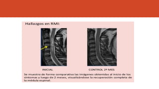 Mielitis transversa | PPTX
