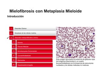 Mielofibrosis con metaplasia mieloide | PPTX
