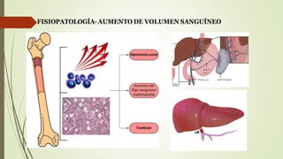 SINDROMES MIELO. MIELOFIBROSIS PRIMARIA 30.6.24.pptx