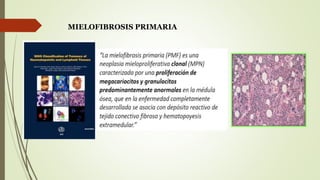 SINDROMES MIELO. MIELOFIBROSIS PRIMARIA 30.6.24.pptx
