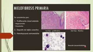 SINDROMES MIELO. MIELOFIBROSIS PRIMARIA 30.6.24.pptx