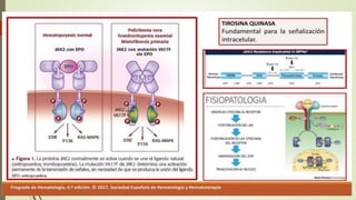 SINDROMES MIELO. MIELOFIBROSIS PRIMARIA 30.6.24.pptx