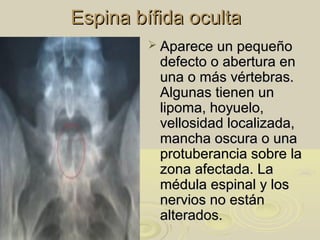 Espina Bífida Oculta Rayos X