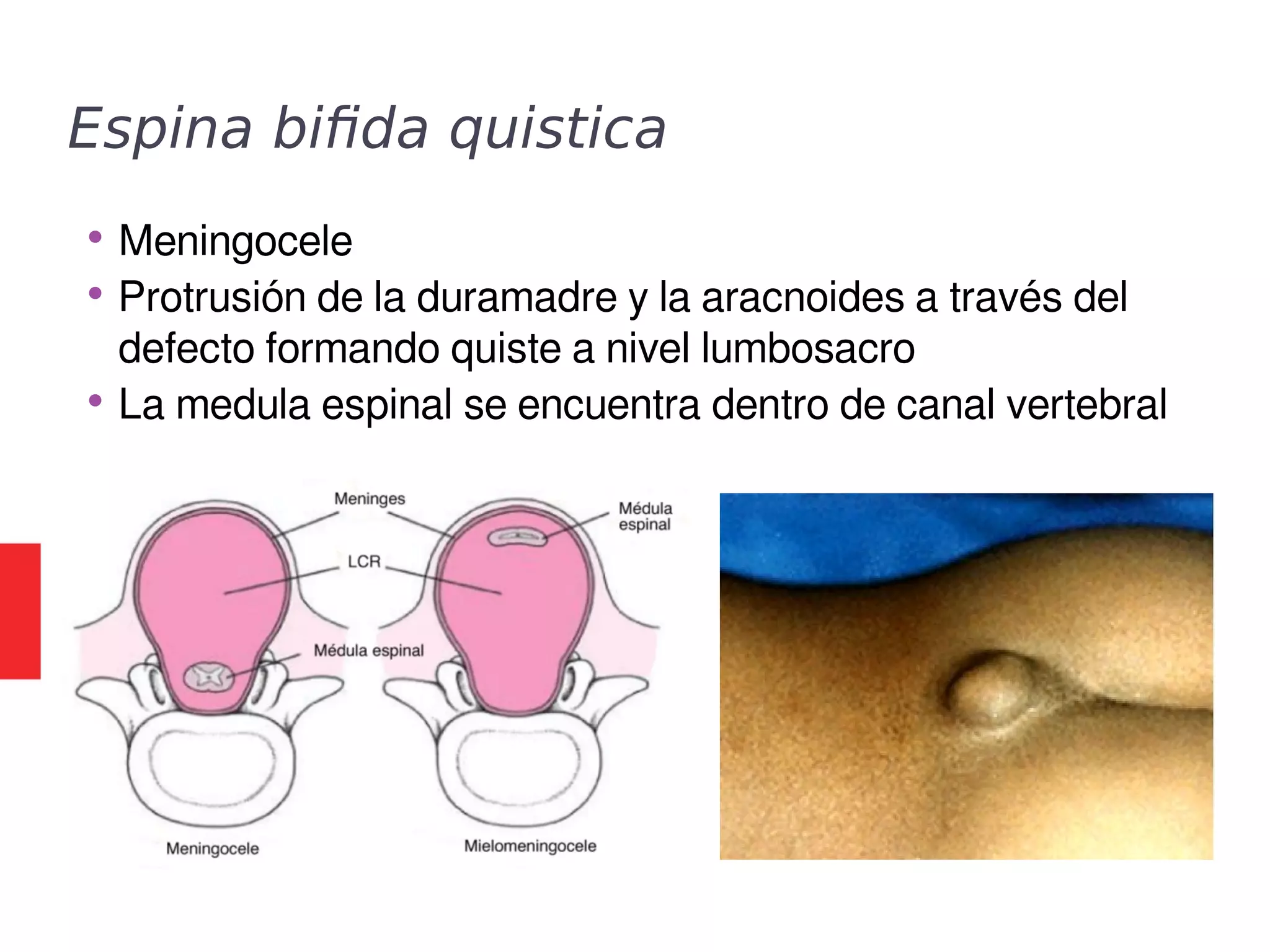Disrafias espinales, conceptos generales y tratamiento no quirurgico | PDF