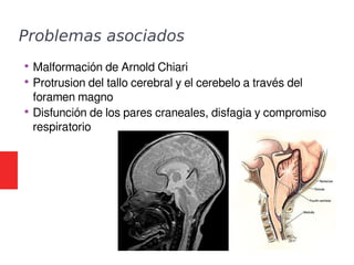 Disrafias espinales, conceptos generales y tratamiento no quirurgico | PDF