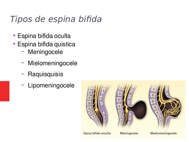 Disrafias espinales, conceptos generales y tratamiento no quirurgico