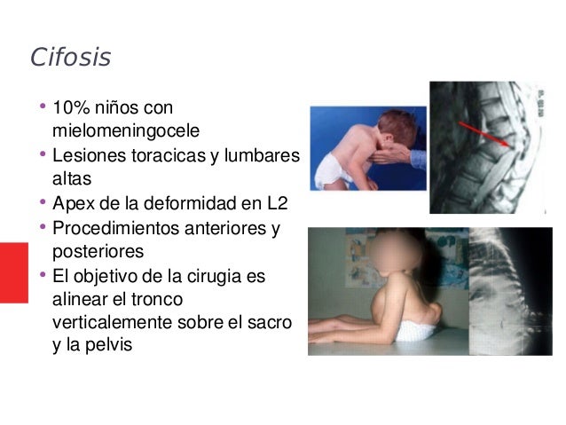 Disrafias espinales, tratamiento quirurgico de deformidades especific…