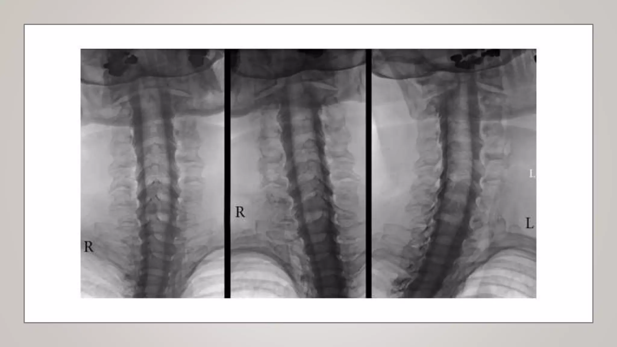 Mielopatia cervical.pptx