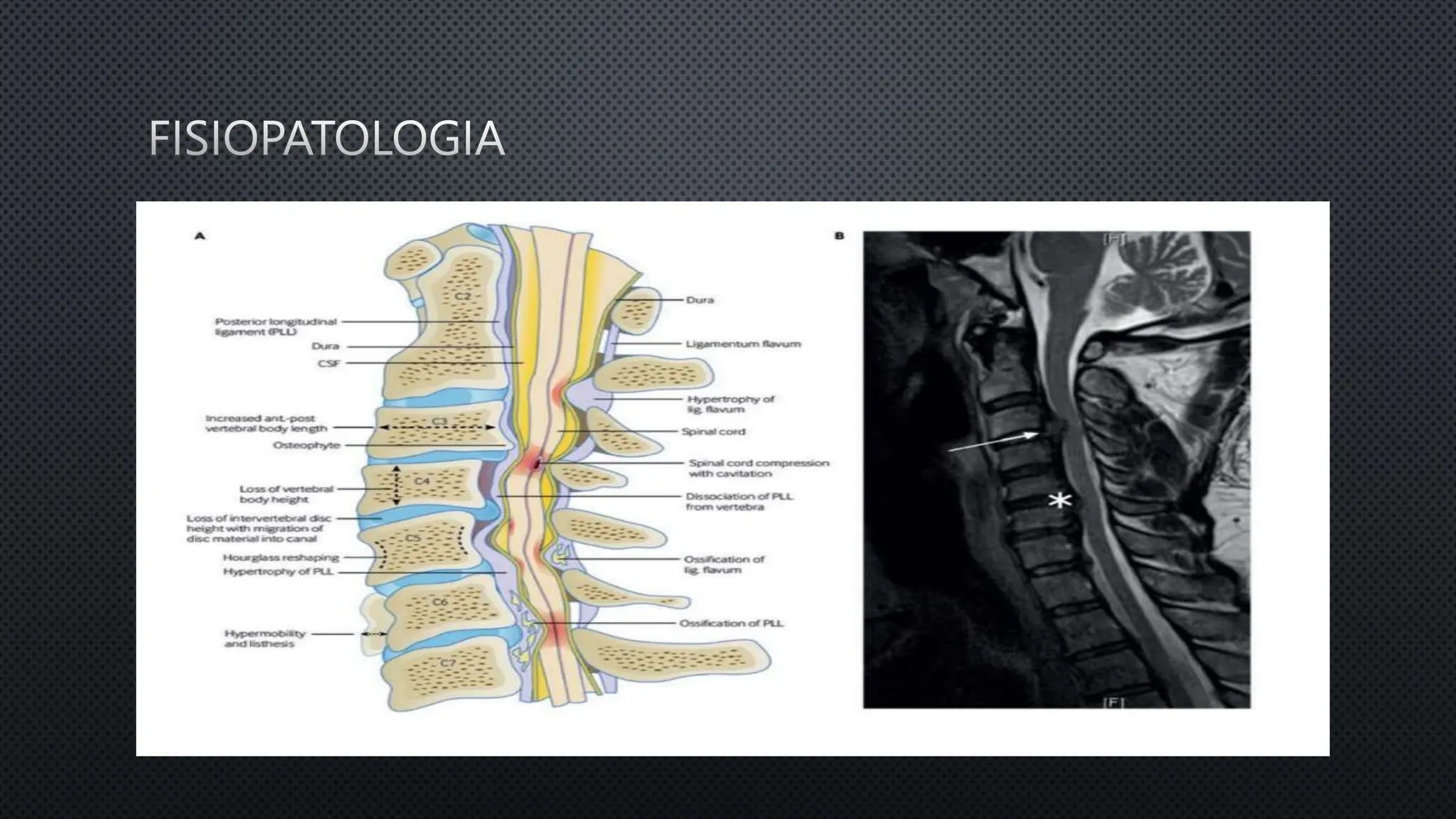 MIELOPATIA CERVICAL ESPONDILOTICA EN EL ADULTO | PPTX