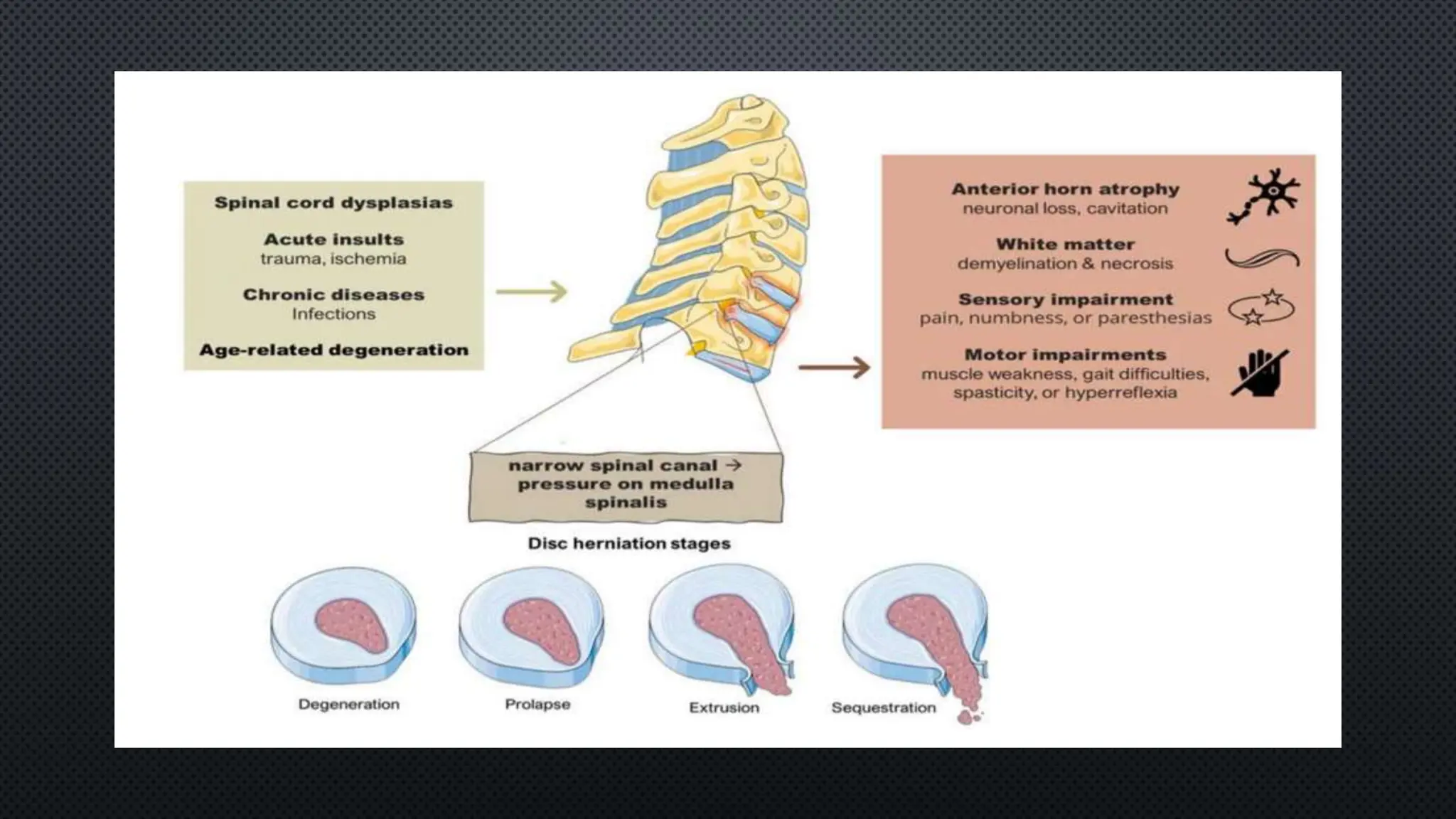 MIELOPATIA CERVICAL ESPONDILOTICA EN EL ADULTO | PPTX