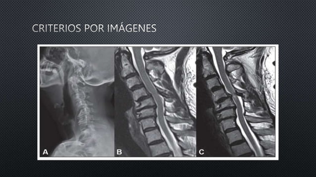 MIELOPATIA CERVICAL ESPONDILOTICA EN EL ADULTO | PPTX