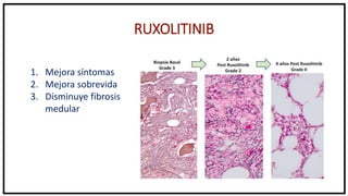 Neoplasias mieloproliferativas Phi(-) | PPTX