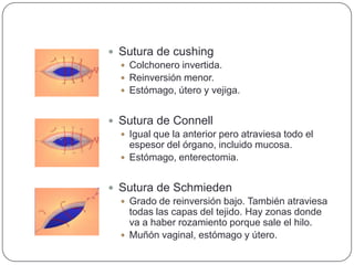 nudos y suturas | PPTX