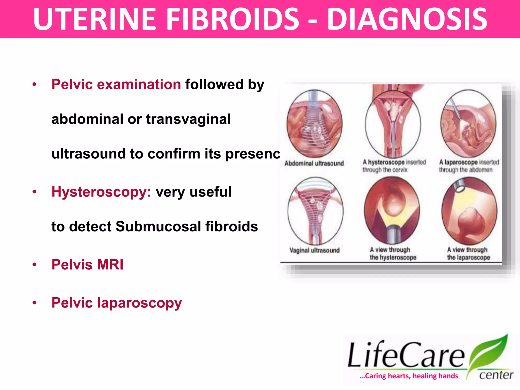 Low Dose Mifeprostone in the Management of Fibroid Dr Sharda Jain | PPTX