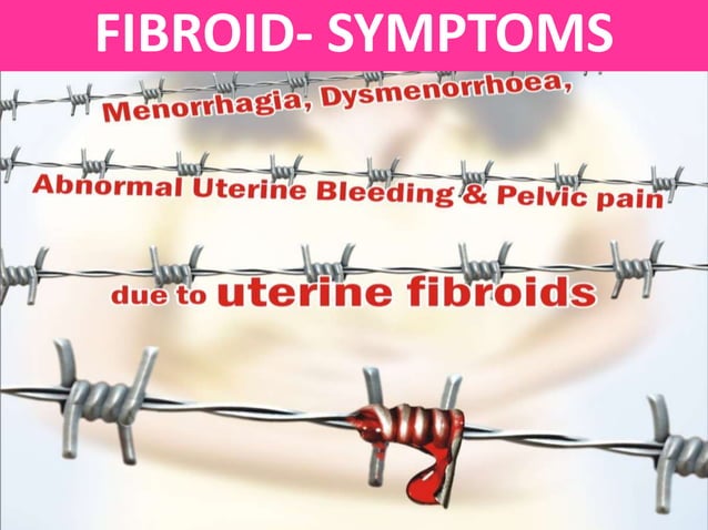 Low Dose Mifeprostone in the Management of Fibroid Dr Sharda Jain | PPTX
