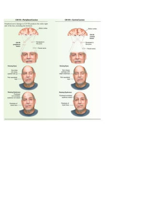 migrain materi neurologi nyeri kepala, vertigo, tth.docx