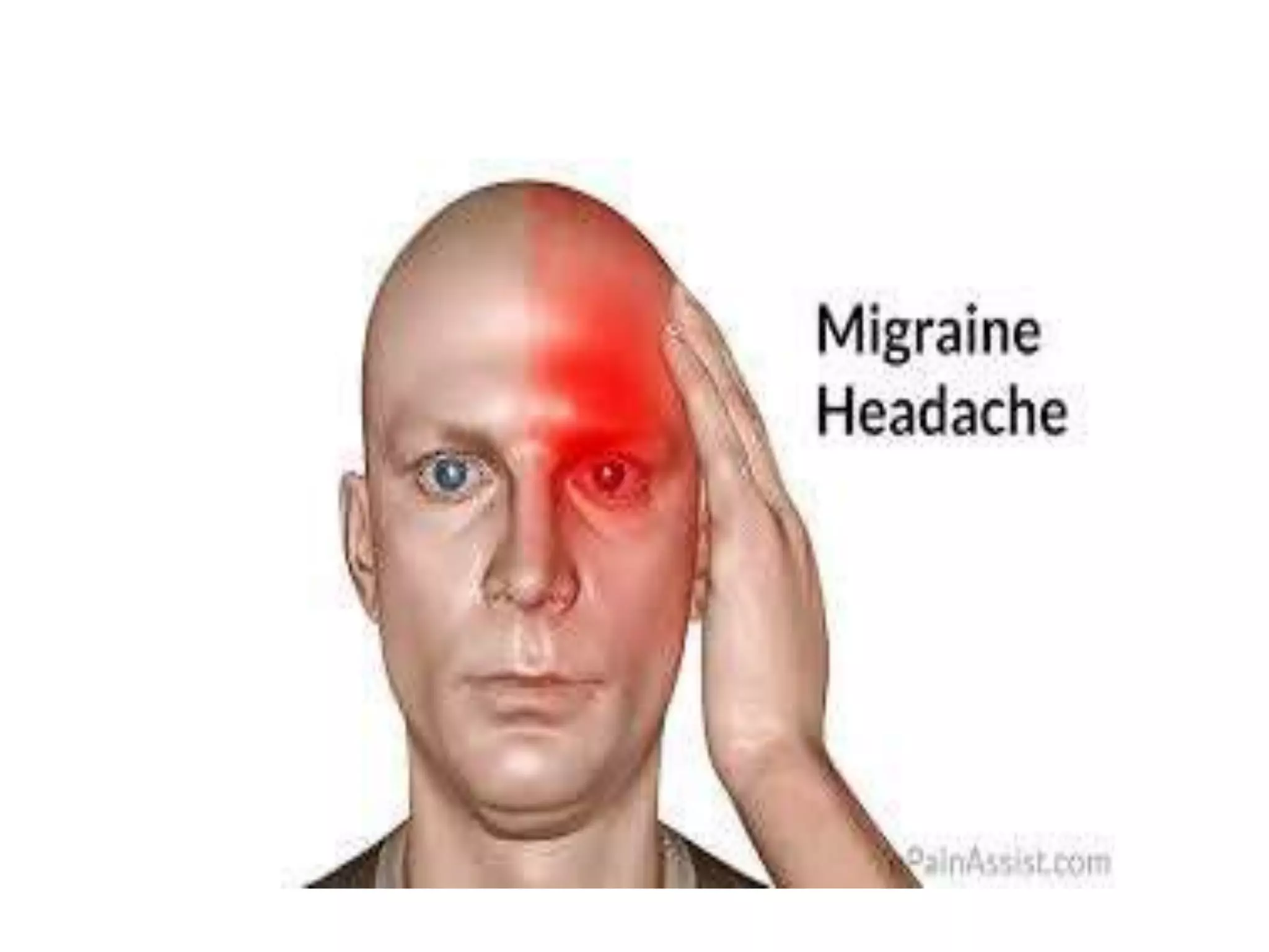 Head ache & Migraine | PPT