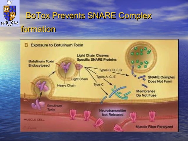 Migraine and BoTox 2013