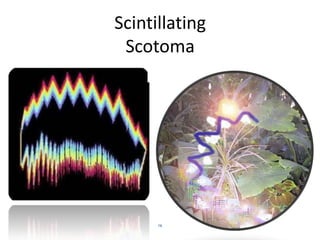 MIGRAINE neurovision 2019.pptx