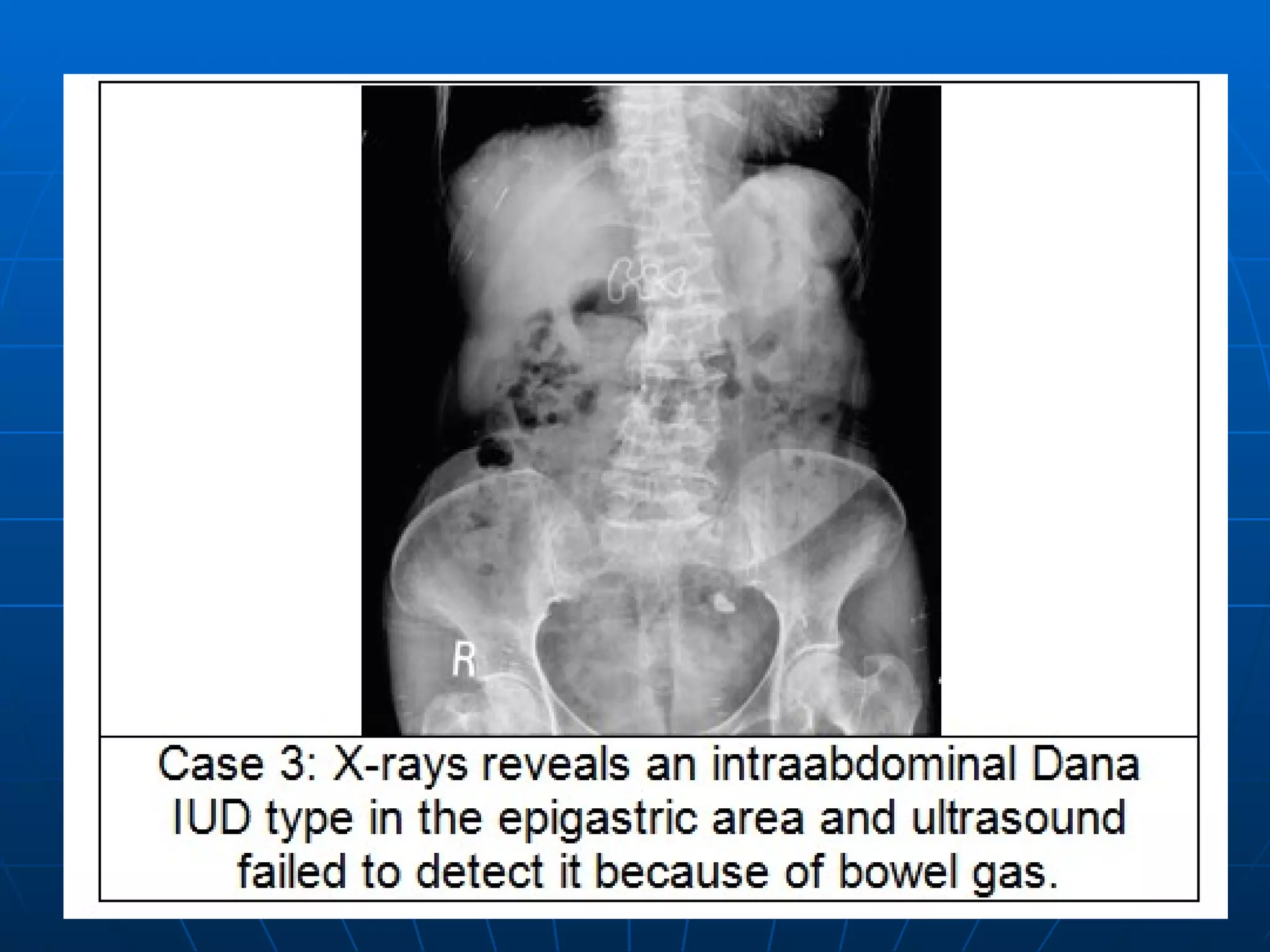 Intraabdominal Migrating of Intrauterine Contraceptive Devices (IUD) | PPT