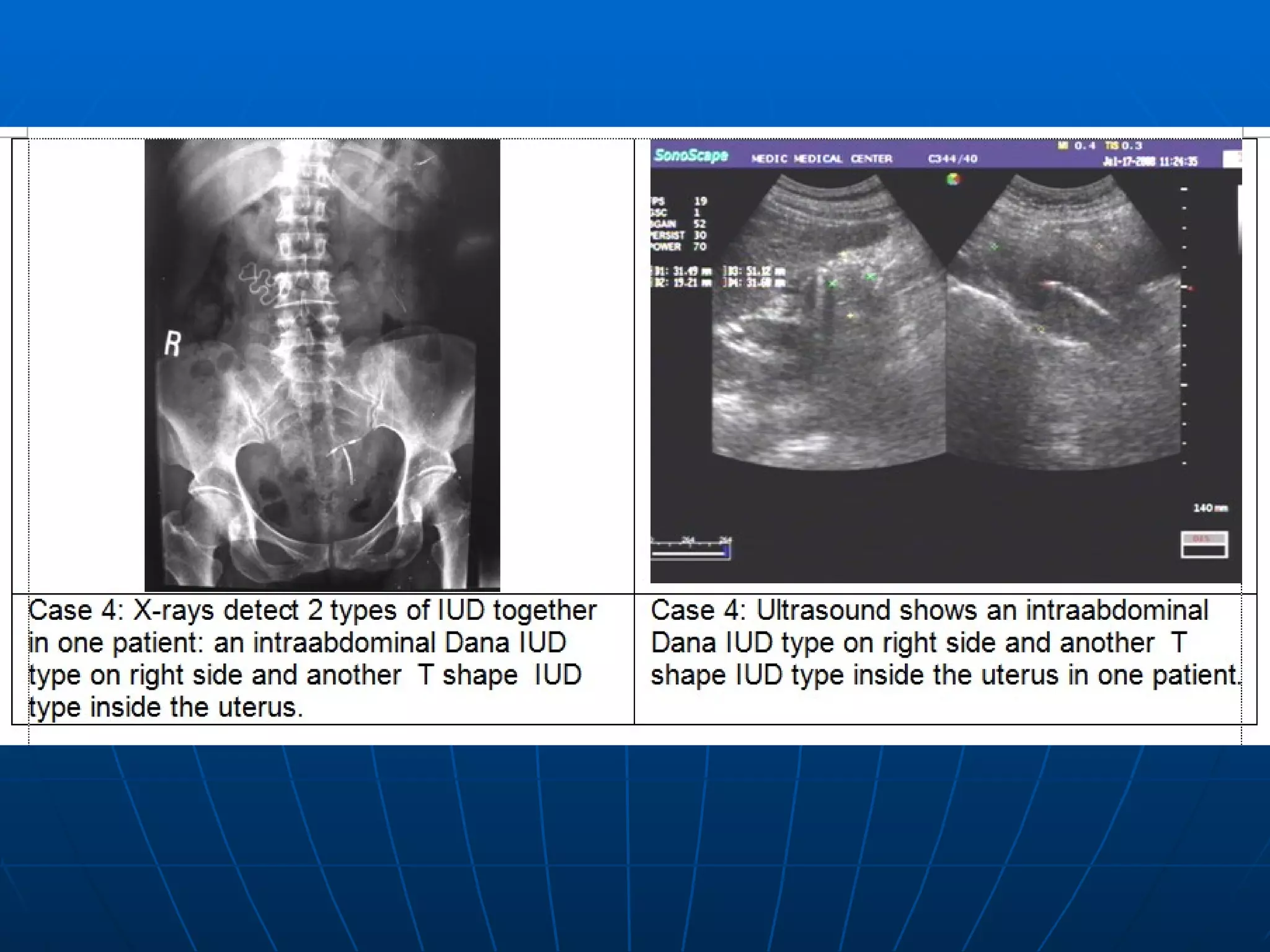 Intraabdominal Migrating of Intrauterine Contraceptive Devices (IUD) | PPT