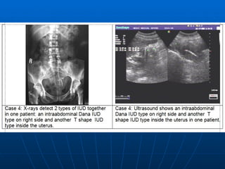 Intraabdominal Migrating of Intrauterine Contraceptive Devices (IUD) | PPT