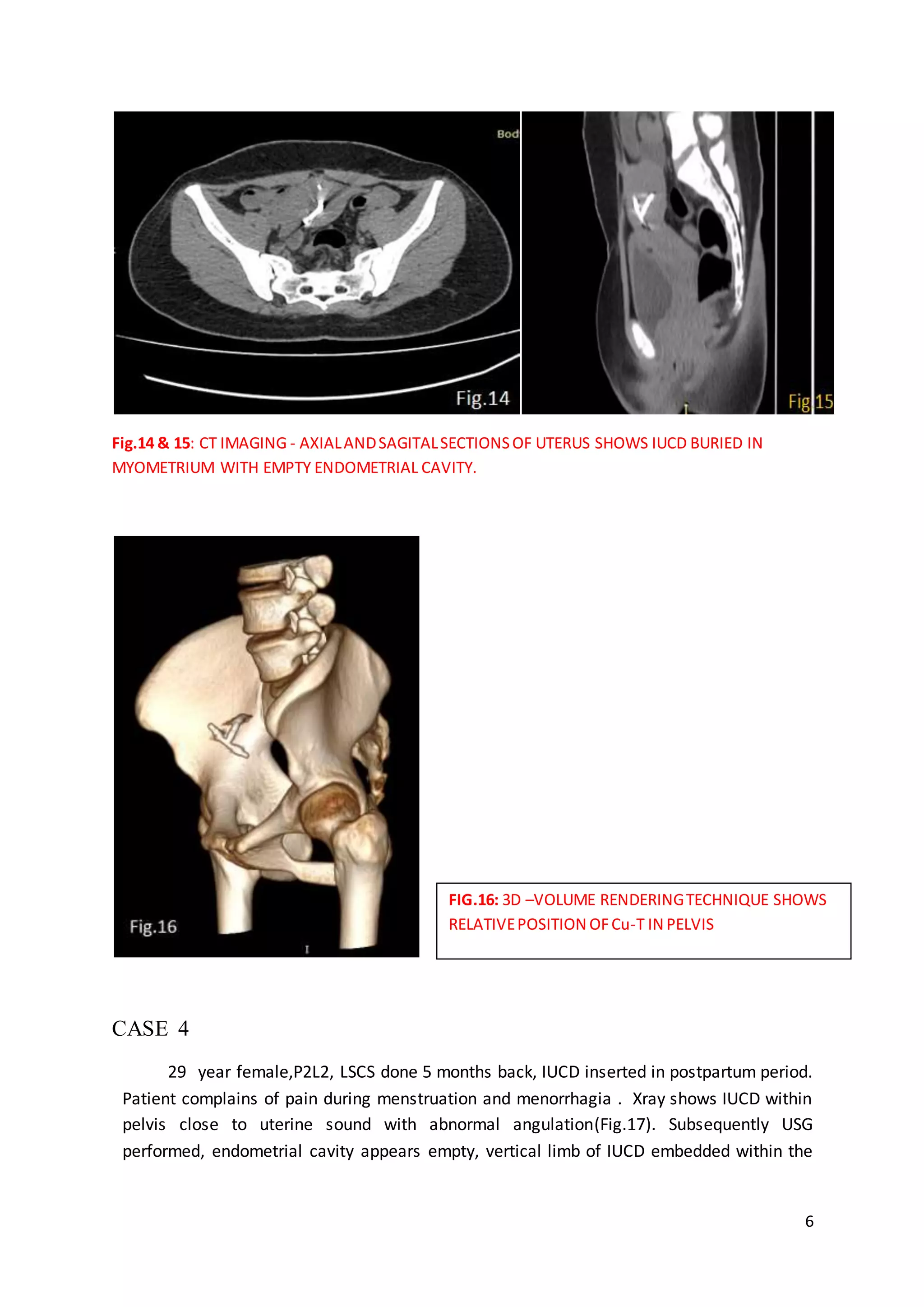 Misplaced IUCD -A Case Study | DOCX