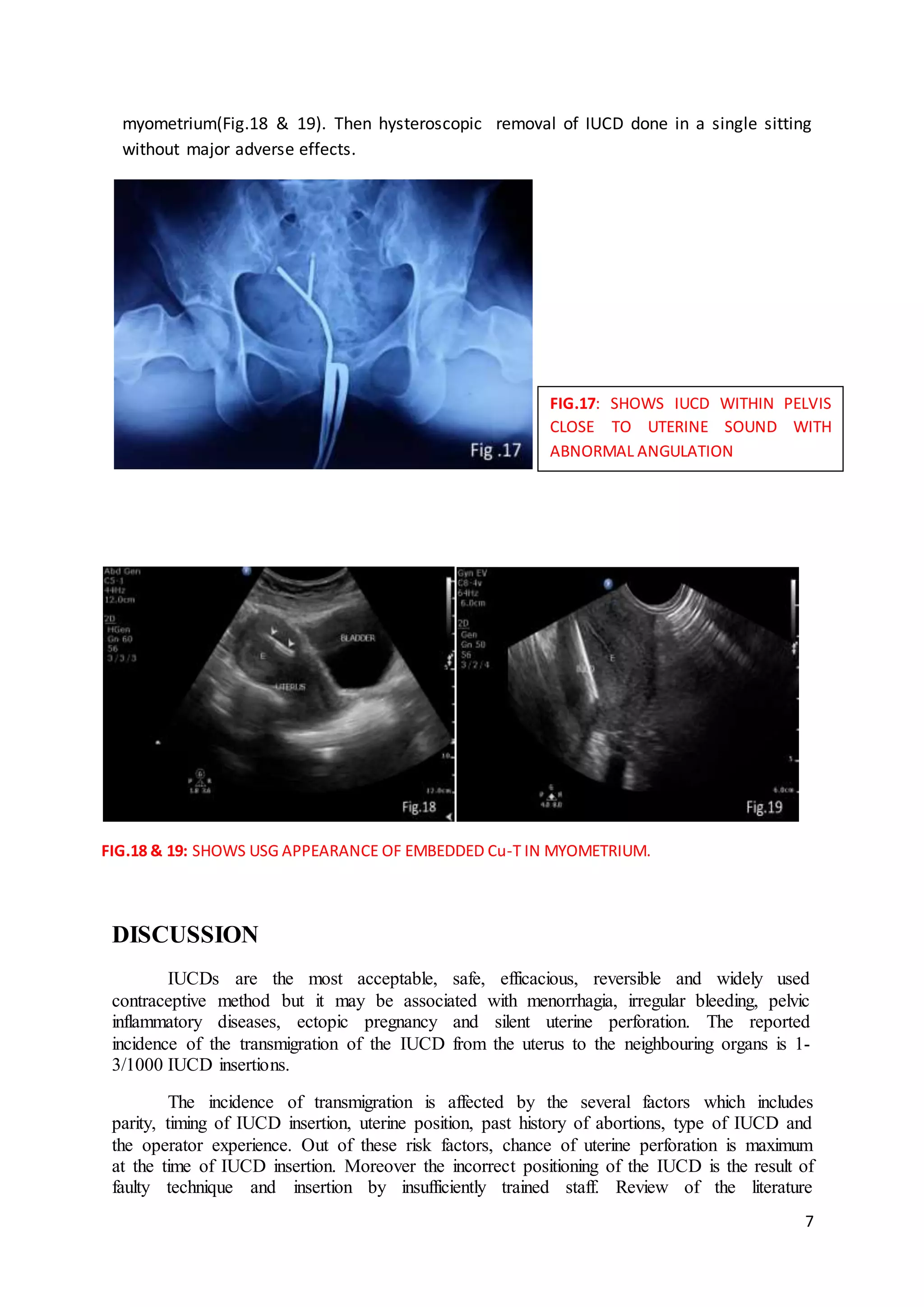 Misplaced IUCD -A Case Study | DOCX