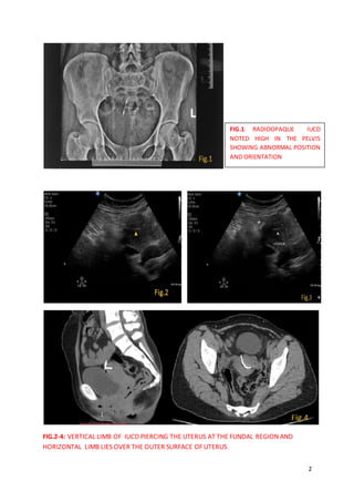 Misplaced IUCD -A Case Study | PDF