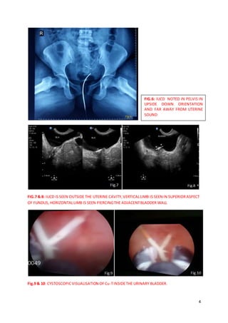 Misplaced IUCD -A Case Study | PDF