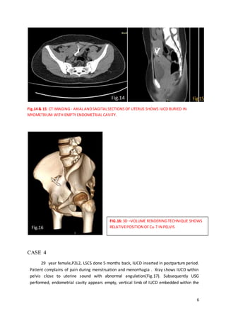 Misplaced IUCD -A Case Study | PDF