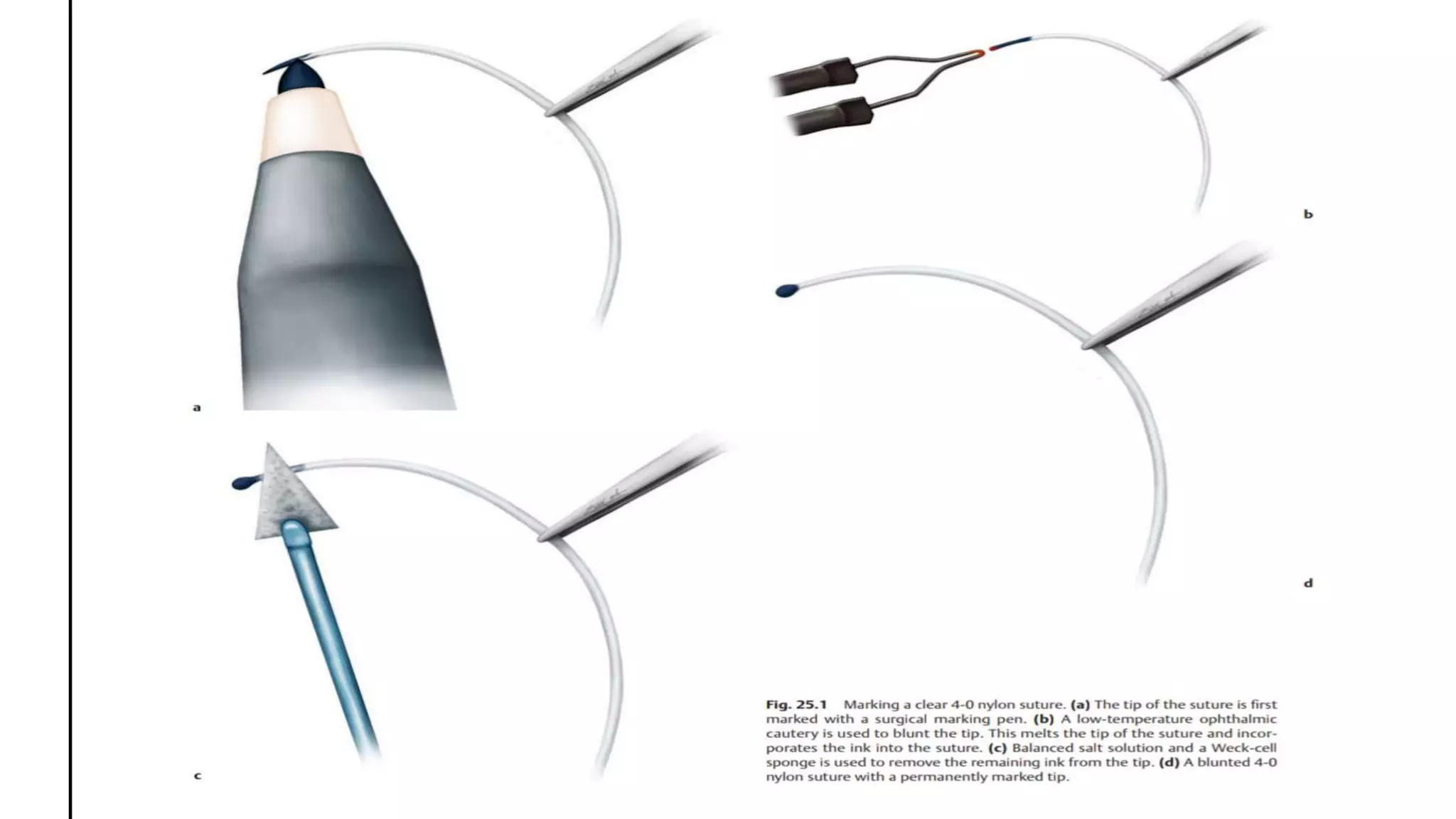 Minimally invasive Glaucoma surgery MIGS | PPTX