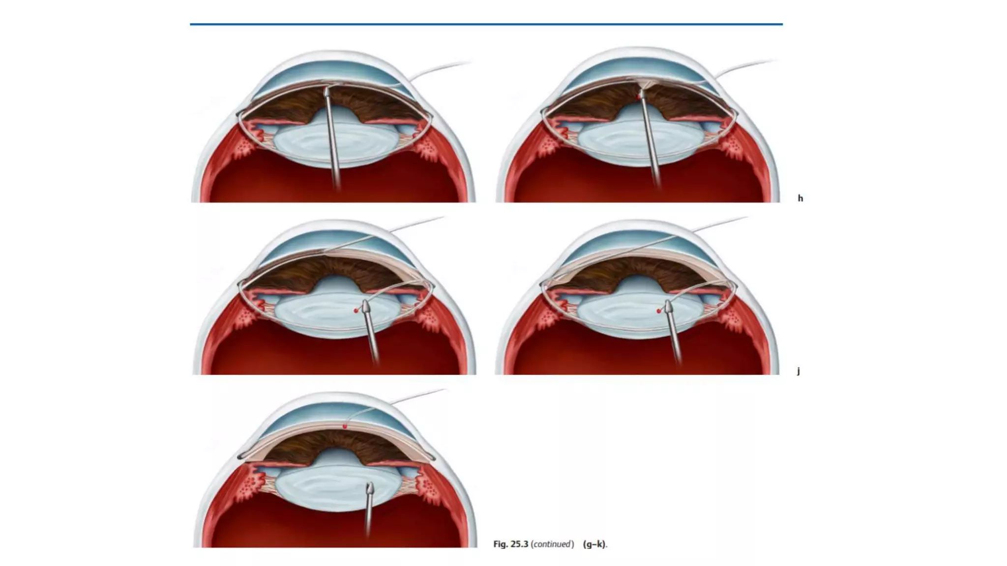 Minimally invasive Glaucoma surgery MIGS | PPTX