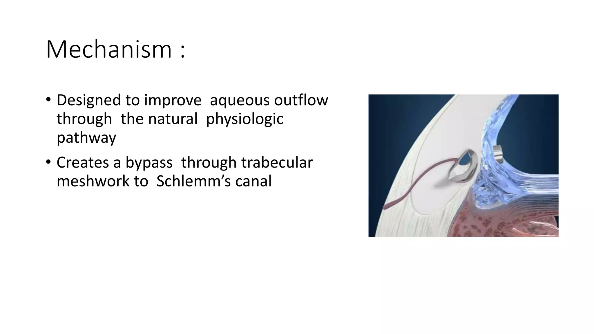 Minimally invasive Glaucoma surgery MIGS | PPTX