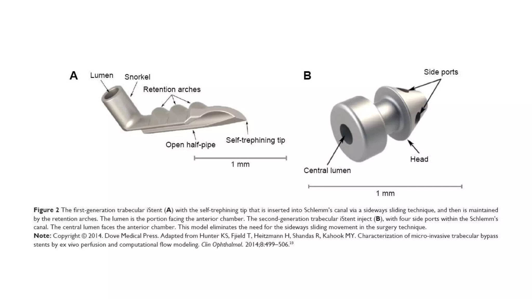 Minimally invasive Glaucoma surgery MIGS | PPTX