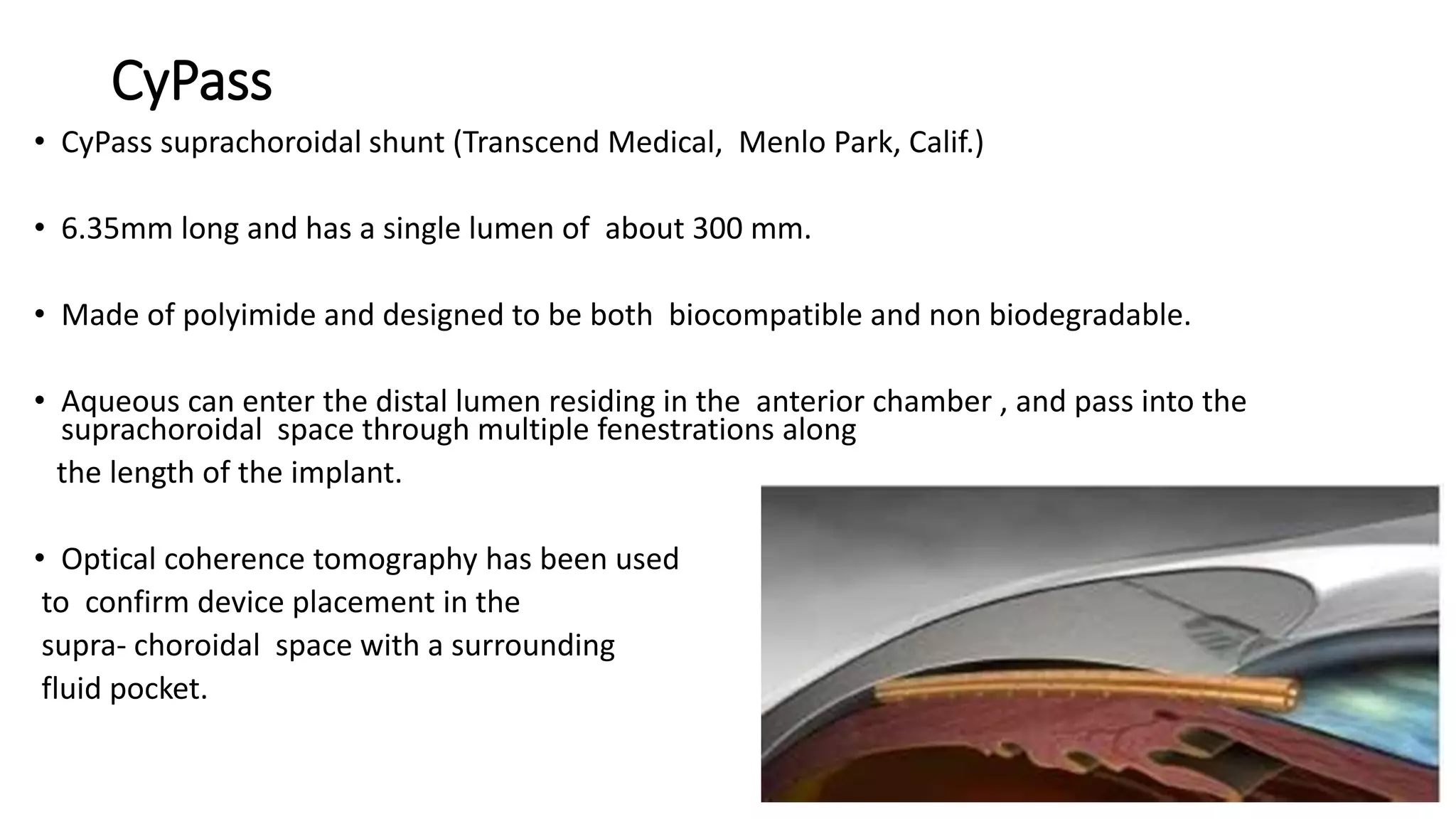 Minimally invasive Glaucoma surgery MIGS | PPTX