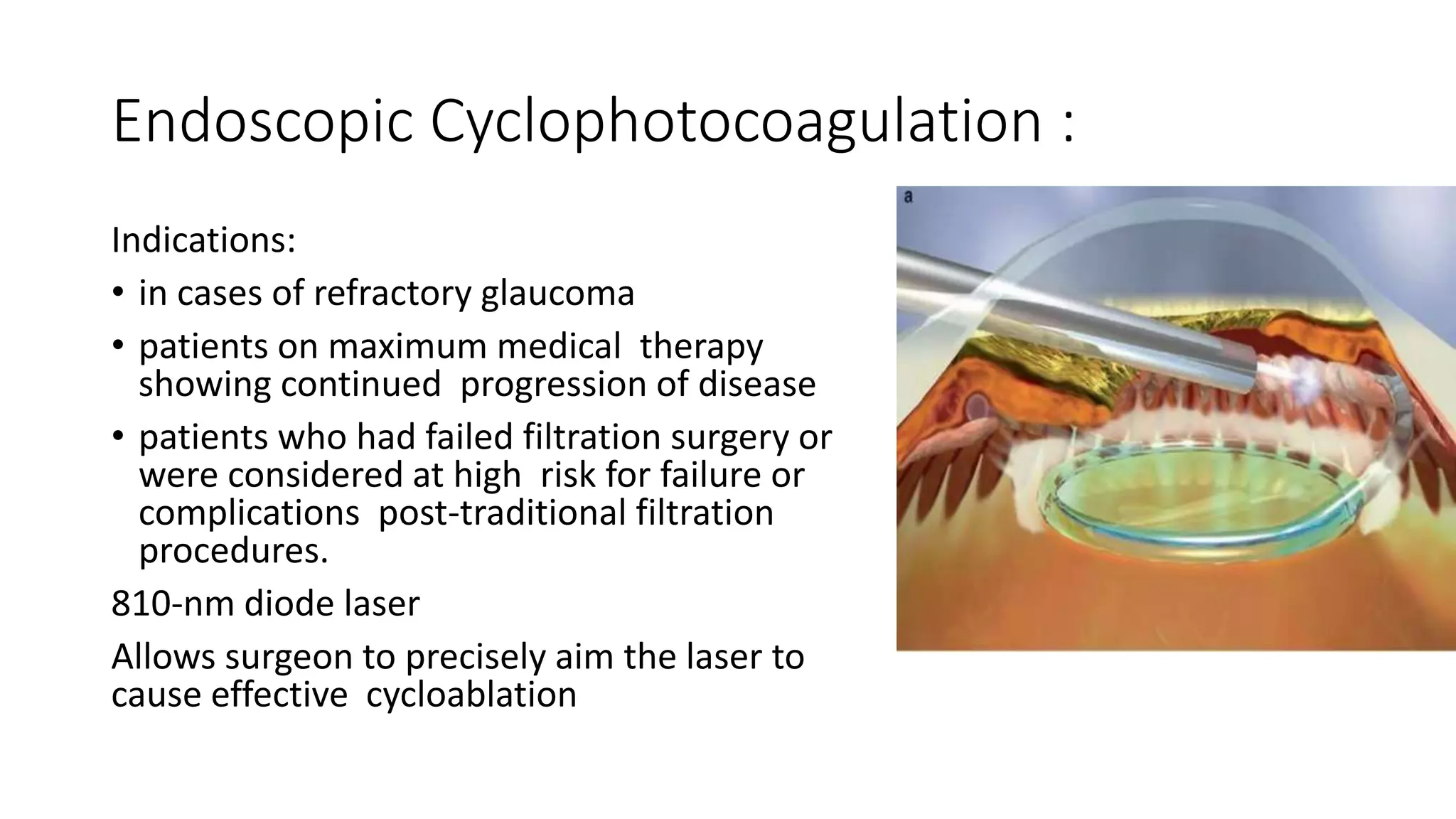 Minimally invasive Glaucoma surgery MIGS | PPTX